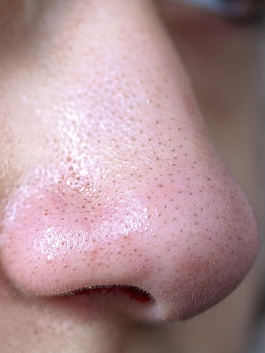 Mitesser entfernen: Verstopfte Poren loswerden